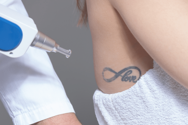 What Should You Know Before Getting Laser Tattoo Removal? | Reno